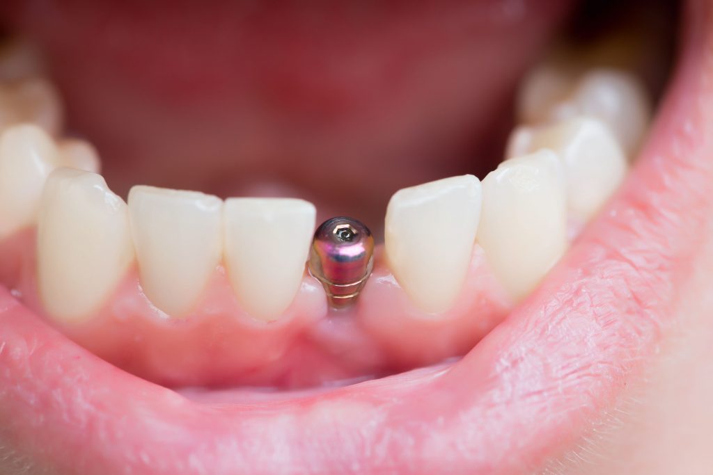 Dental Implant In Iran | Medpersia Medical Tourism