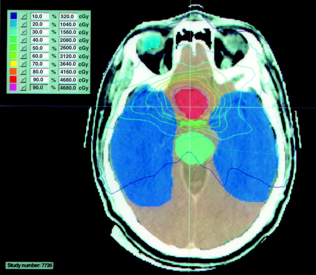 Intensity Modulated Radiation Therapy (IMRT) In Iran | Medpersia ...